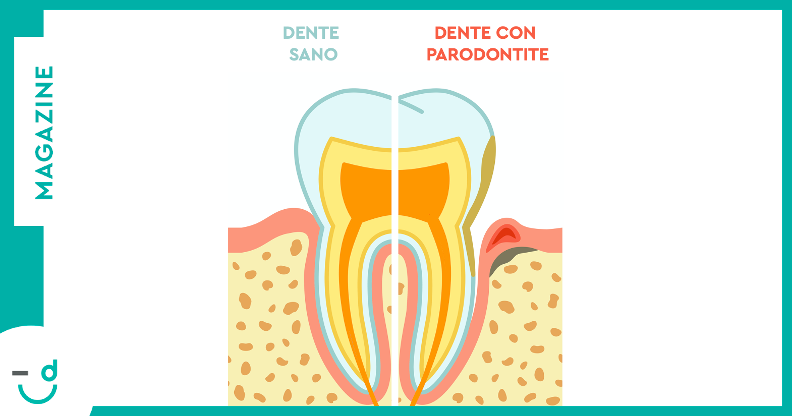 La parodontite: tutto quello che devi sapere