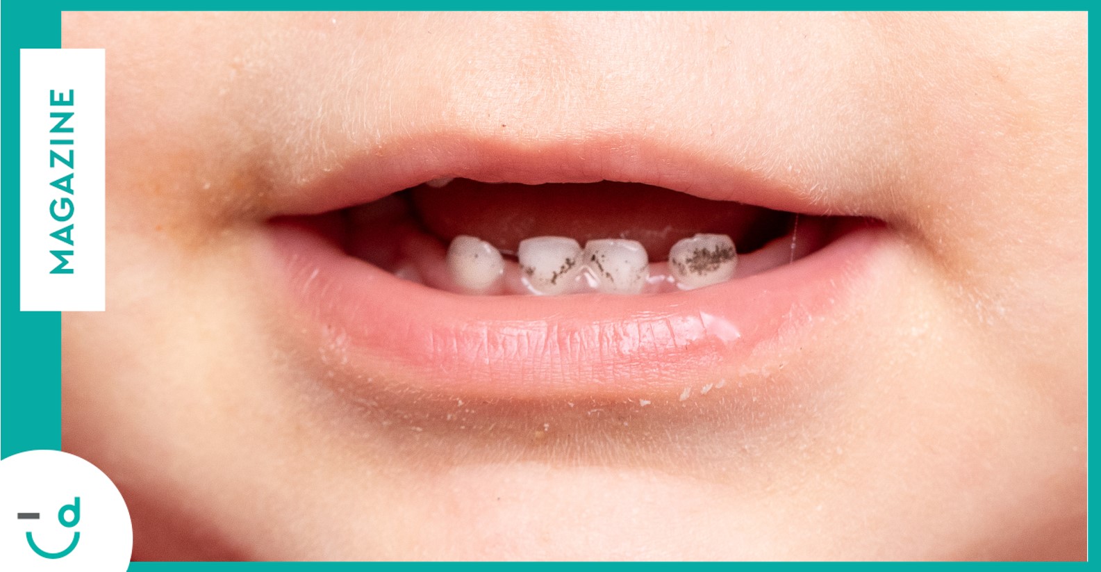 Le black stain: cosa sono queste macchie nere sui denti?